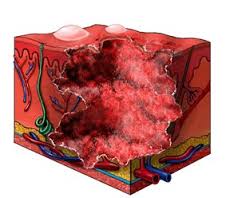 What to Put On a Burn | Healthcare-Online