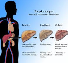 Alcoholic Hepatitis | Healthcare-Online